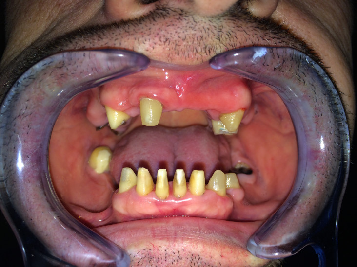 Coroane metalo-ceramica | caz - coroana zirconiu